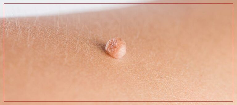 How Much Does Skin Tag Removal Cost? | Dr. Timothy Mullally